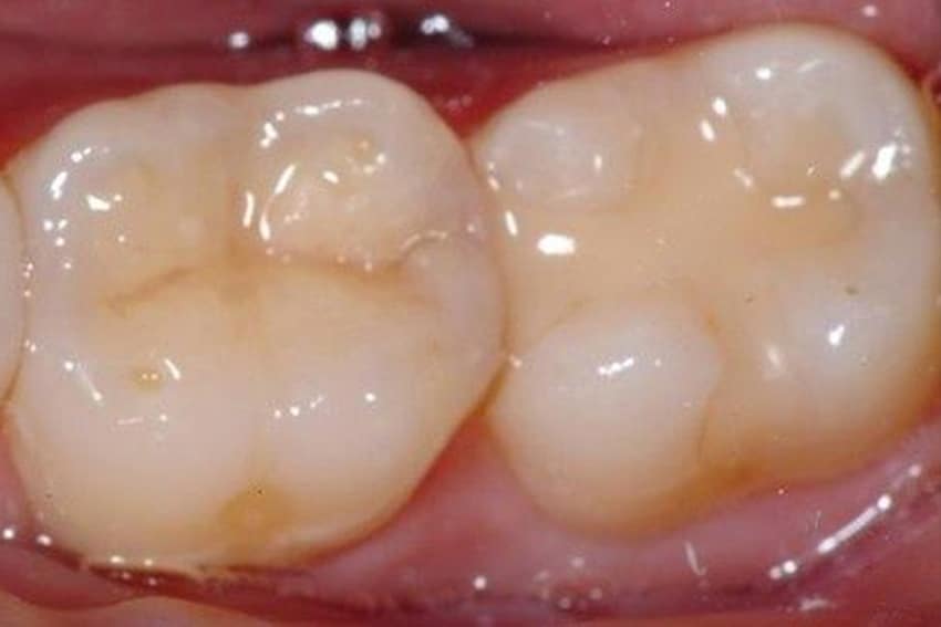 Tooth Colored Fillings - Tepe Dentistry - Colleen Tepe Hofstetter, DDS